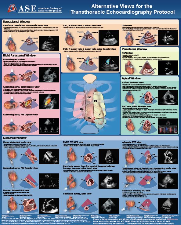 Comprehensive TTE Guideline Poster Bundle (4 Posters)